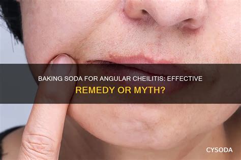Baking Soda For Angular Cheilitis Effective Remedy Or Myth Cysoda