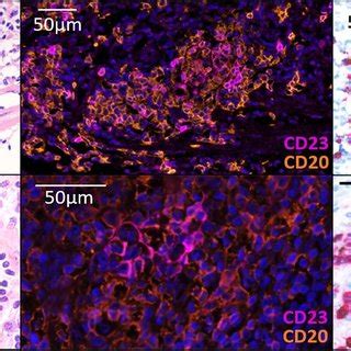 Comparison Of The TLS Screening With Pathology And Immunohistochemistry Download Scientific