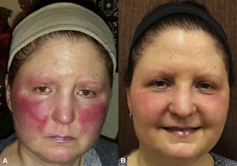 Autoimmune Progesterone Dermatitis Mimicking Facial Erythromelalgia
