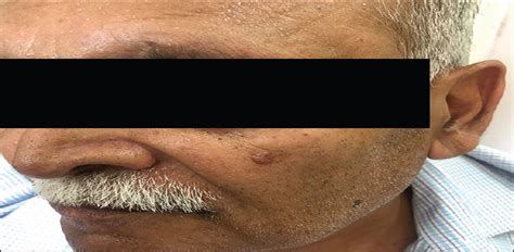 Dermoscopy Of Granuloma Faciale In The Skin Of Color Indian Dermatology Online Journal
