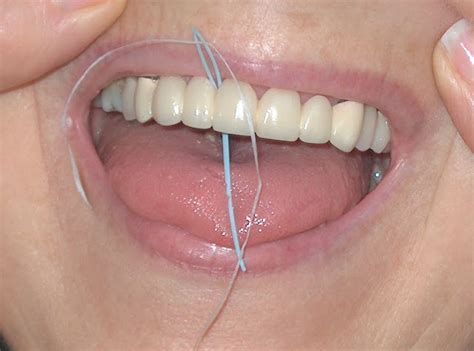 Bridge Garden Picture Bridge Dental Floss