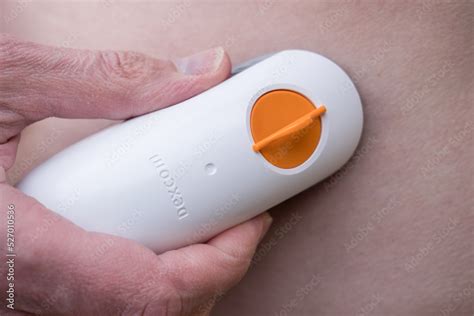 Sydney Australia CGM Continuous Glucose Monitoring Dexcom G Sensor