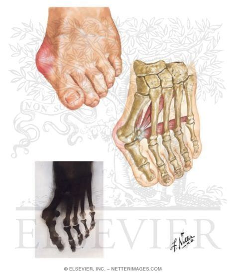 Metatarsus Primus Varus