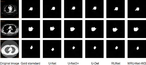 Figure 1 From Segmentation Of Pulmonary Nodules Based On Mrbu Net Wd