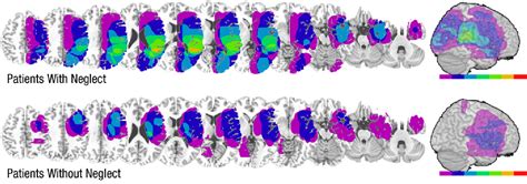 Figure 1 From Patients With Left Spatial Neglect Also Neglect The “left Side” Of Time Semantic
