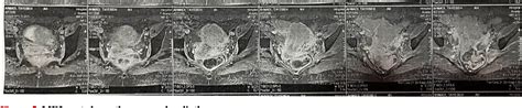 Figure 1 From Primary Uterine Cervix B Cell Lymphoma A Case Report And