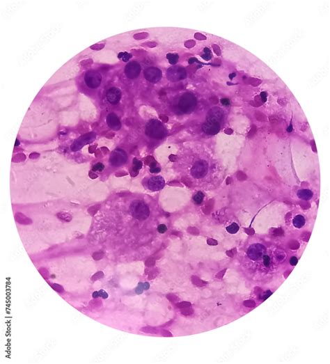 Fotografia Do Stock Fna Cytology Of Swelling Of Chest Wall Infected Epidermal Inclusion Cyst