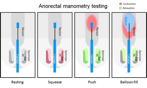 Anorectal Manometry Gi Motility Disorders Unit Western Sydney University