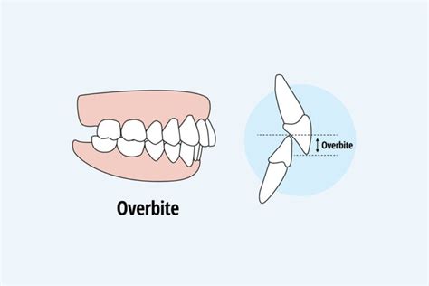 Overbite Vs Normal Bite Differences Causes And Treatment