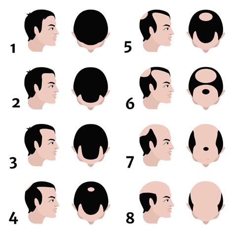 Male Pattern Baldness Treatment Chatswood