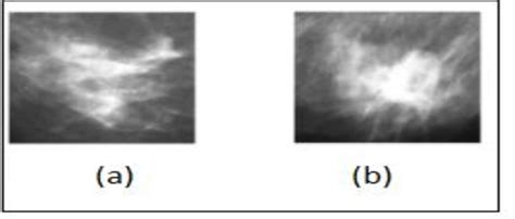 Image Samples From Bcdr Dataset A Benign Masses And B Malignant