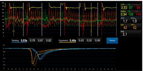 Microvascular Assessment With The Bolus Thermodilution Method Showing Download Scientific