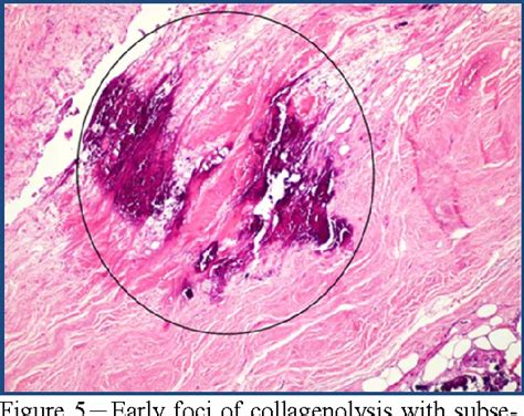 Figure 5 From Calcinosis Cutis Calcinosis Circumscripta And “ Mille