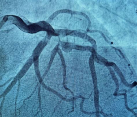 Pci Of Proximal Lad And Aneurysmectomy Vittorio Virga