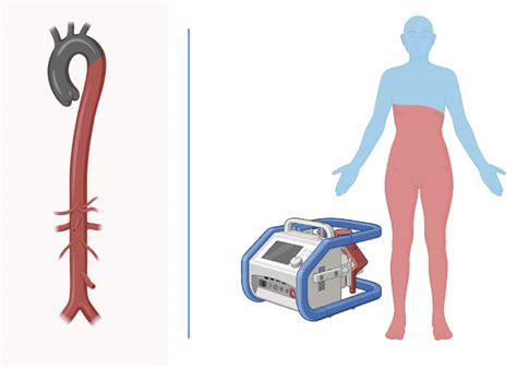 CV EMCrit MCS Minute Series Differential Gas Exchange On Peripheral Femoral VA ECMO With Trina