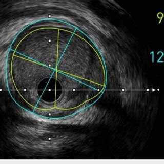 IVUS Of The Mid LAD Confirming A Type I SCAD With A Luminal Area Of Download Scientific