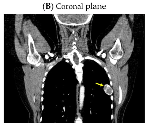Brown Tumors The Hidden Face Of Primary And Renal Hyperparathyroidism