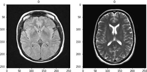 Figure 31 From Convolutional Neural Networks For Mri Based Brain Tumor