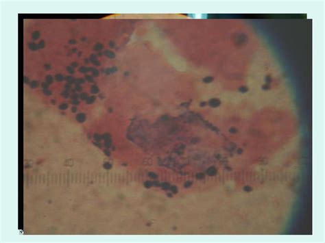 Cryptococcal Infections In Patients With Aids Ppt Download