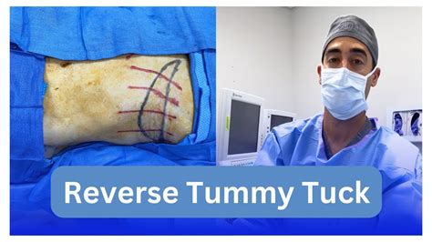 Reverse Tummy Tuck With Dr Zuri In Miami Zuri Plastic Surgery Youtube