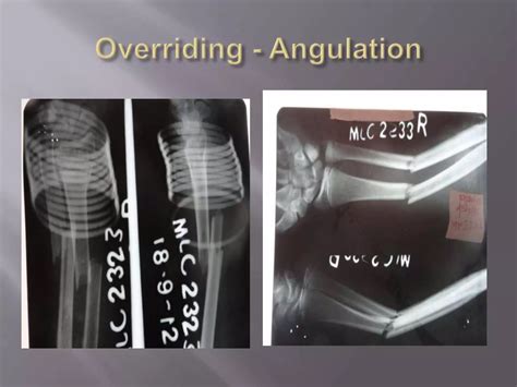 1 2 Fracture Classification And Management Ppt 1 2 Fracture Classification And Management Ppt