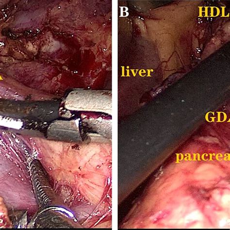 No12a Lymph Node Dissection In Front Of Portal Vein Download