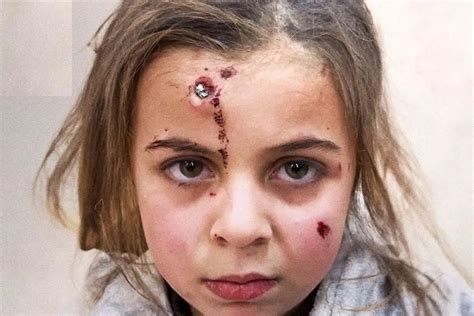 ویدئو خونسردی عجیب دختربچه فلسطینی با ترکش در پیشانی