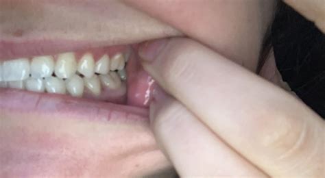 Braces After TMJ Splint R TMJ