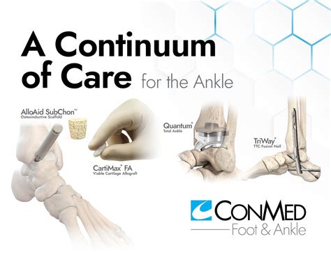 Conmed Foot And Ankle On Linkedin Footandanklesurgery Anklefracture Anklefusion Anklecontinuum