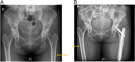 A Radiology Of Pelvis Displaying Cortical Thickening And Beaking Of Download Scientific