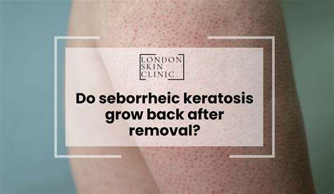 Seborrheic Keratosis Seborrheic Keratosis Clinical Pathology