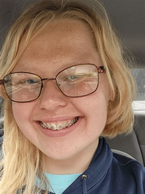 Just Got Interproximal Reduction Ipr To Reduce My Black Triangle And The Results Are