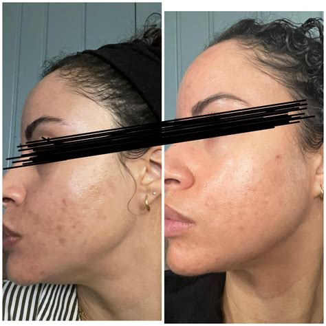 Before And After Two Weeks Of Using Red Light Therapy For