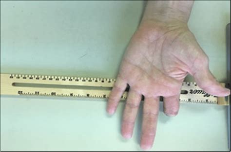 Research Subject With Amputation At The Proximal Interphalangeal Joint Download Scientific
