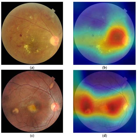 A Multi Label Detection Deep Learning Model With Attention Guided Image Enhancement For Retinal