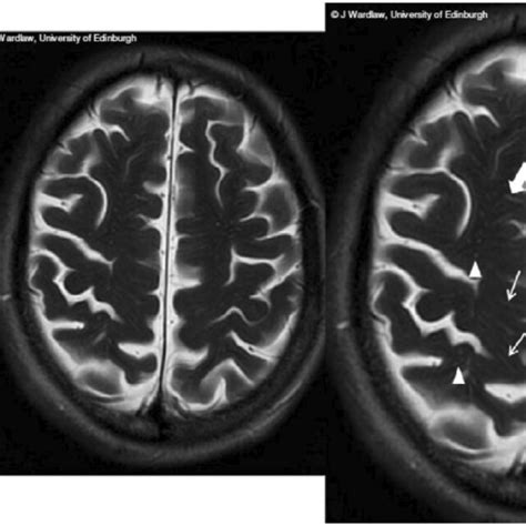 Enlarged Perivascular Spaces On Mri Source Taken From Reference 31 Download Scientific