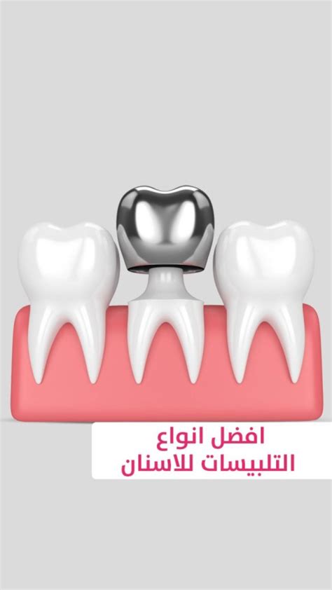 تجميل الأسنان الأمامية تجميل الأسنان الأمامية بدون تقويم