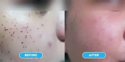 Warts Removal In Dubai Euromed® Clinic