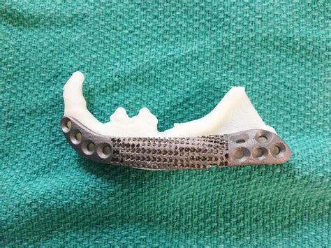 Mandibulectomy Prosthesis — Dr Julius Liptak