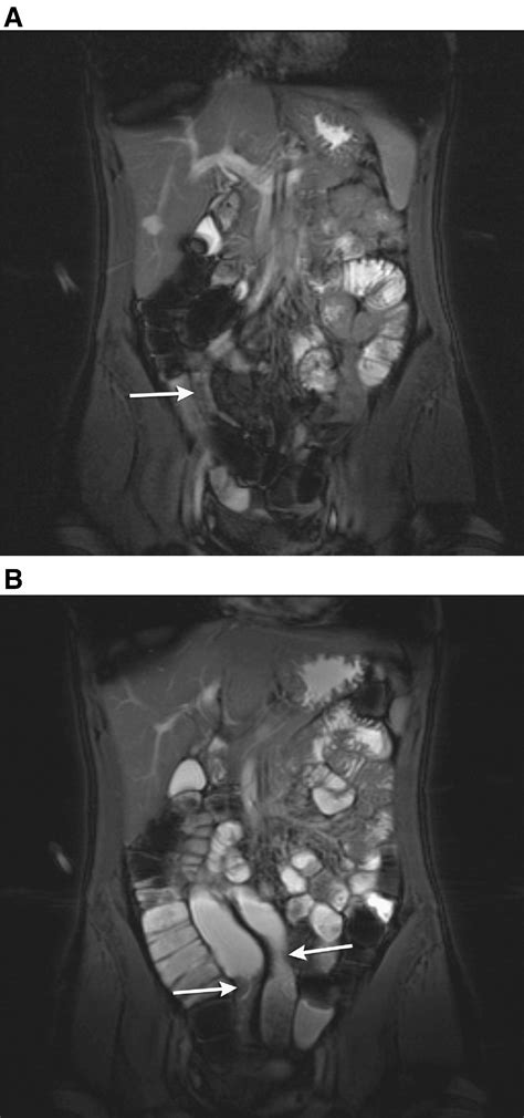 Magnetic Resonance Imaging Of The Small Bowel With The True Fisp