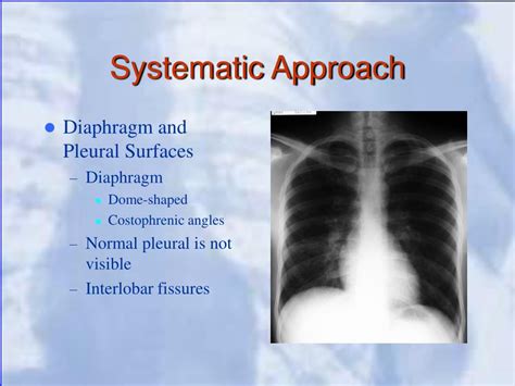 Ppt Chest X Ray Interpretation Powerpoint Presentation Free Download