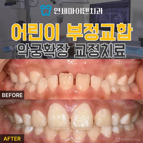 어린이 부정교합 교정치료 영구치가 나고있다면 광화문치과 연세마이덴치과🦷