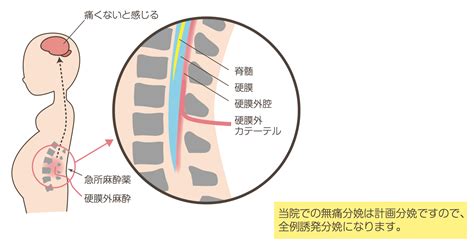 無痛分娩 島根大学医学部附属病院 産科婦人科