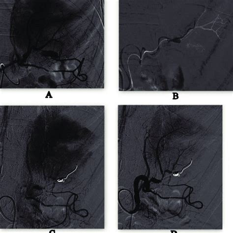 Pdf Splenic Artery Embolization Endovascular And Percutaneous Trans Splenic Approach