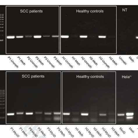 Detection Of Methylation Status Of The Novel Cpg Sites Using Msp A Download Scientific