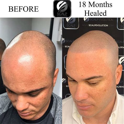 Why Choose Scalp Micropigmentation Florida Scalp Evolution