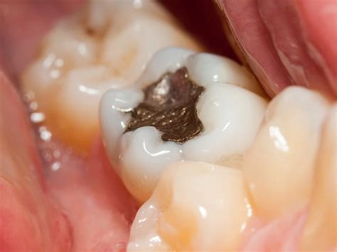 What Are Tooth Colored Fillings