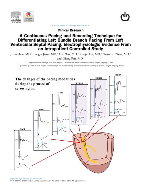 Pdf A Continuous Pacing And Recording Technique For Differentiating Left Bundle Branch Pacing