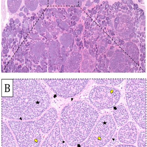 Histopathological Analysis Of The Scalp Lesion Before Ect Treatment