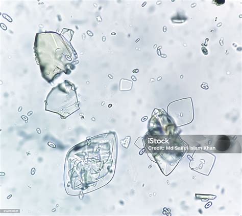 Uric Acid Crystals And Calcium Oxalate Monohydrate Under Microscope